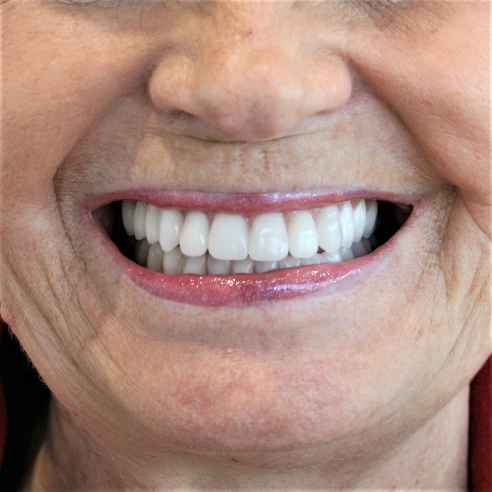 Simply beautiful smile! — Pearl Denture & Implant Centre | Edmonton, AB