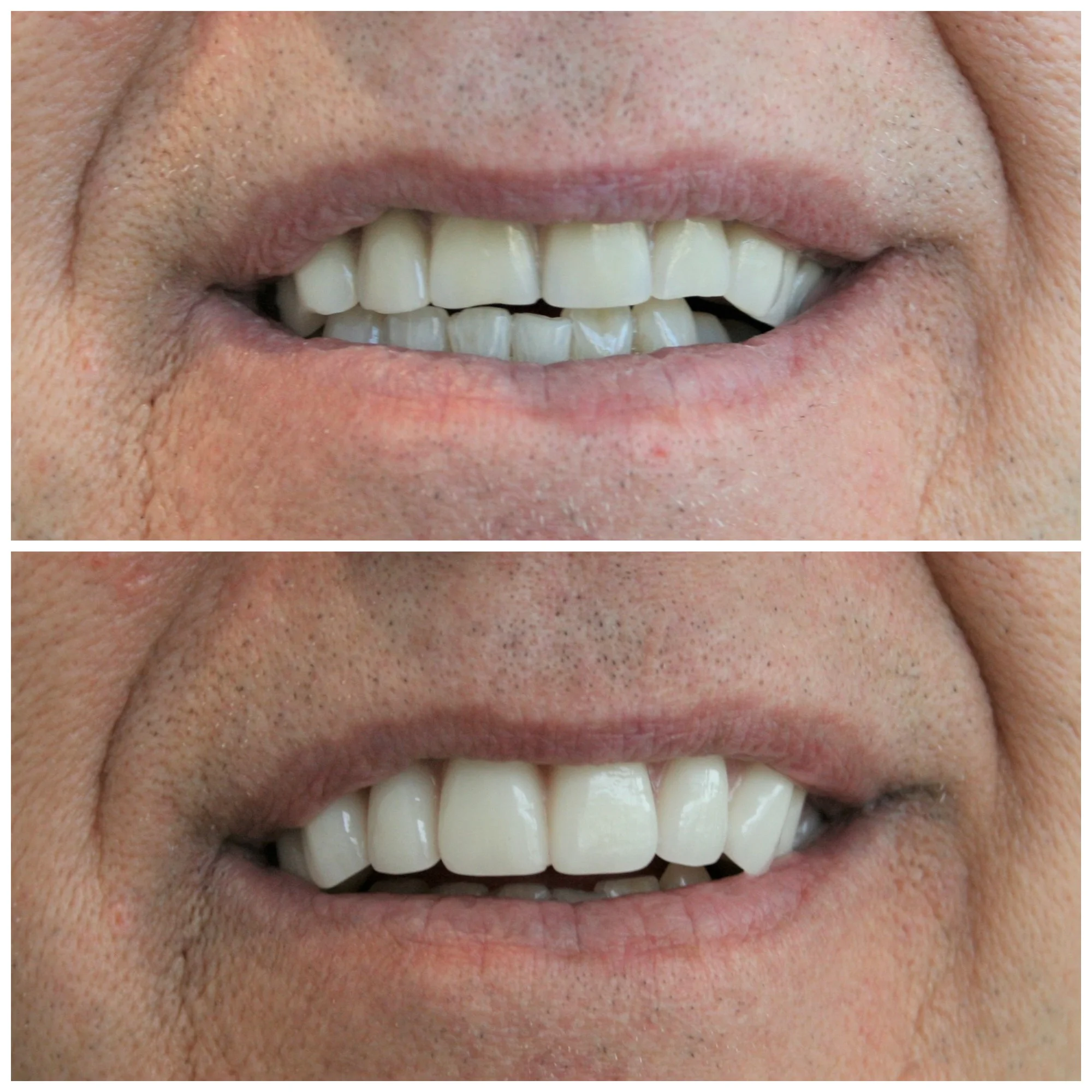 New Smile! — Pearl Denture & Implant Centre | Edmonton, AB