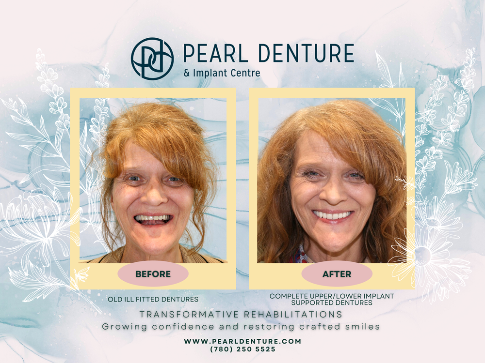 Implant Overdentures — Pearl Denture & Implant Centre