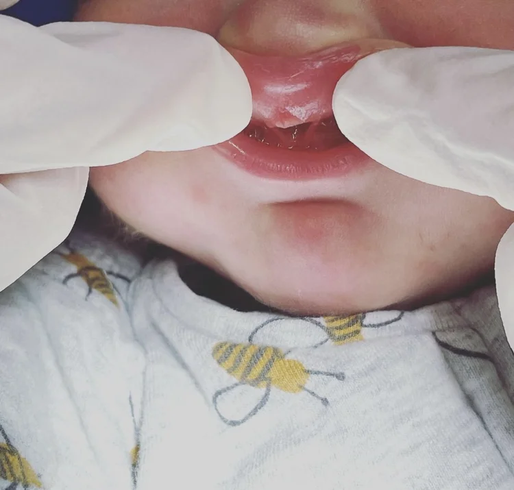 Baby & Adult Lip Tie and Tongue Tie Release in Sydney Pain Free Dentist Hurlstone Park, Dulwich ...