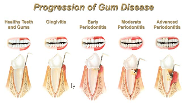 Tooth decay — Pain Free Dentist Sydney