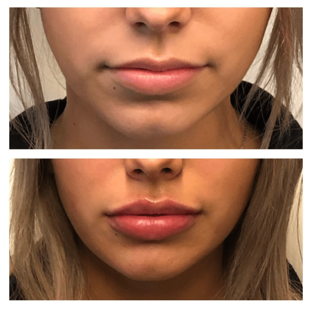 Benefits of Lip Injections or Lip Fillers — Pain Free Dentist Sydney