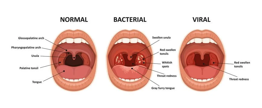 Why is my uvula swollen? — Pain Free Dentist Sydney