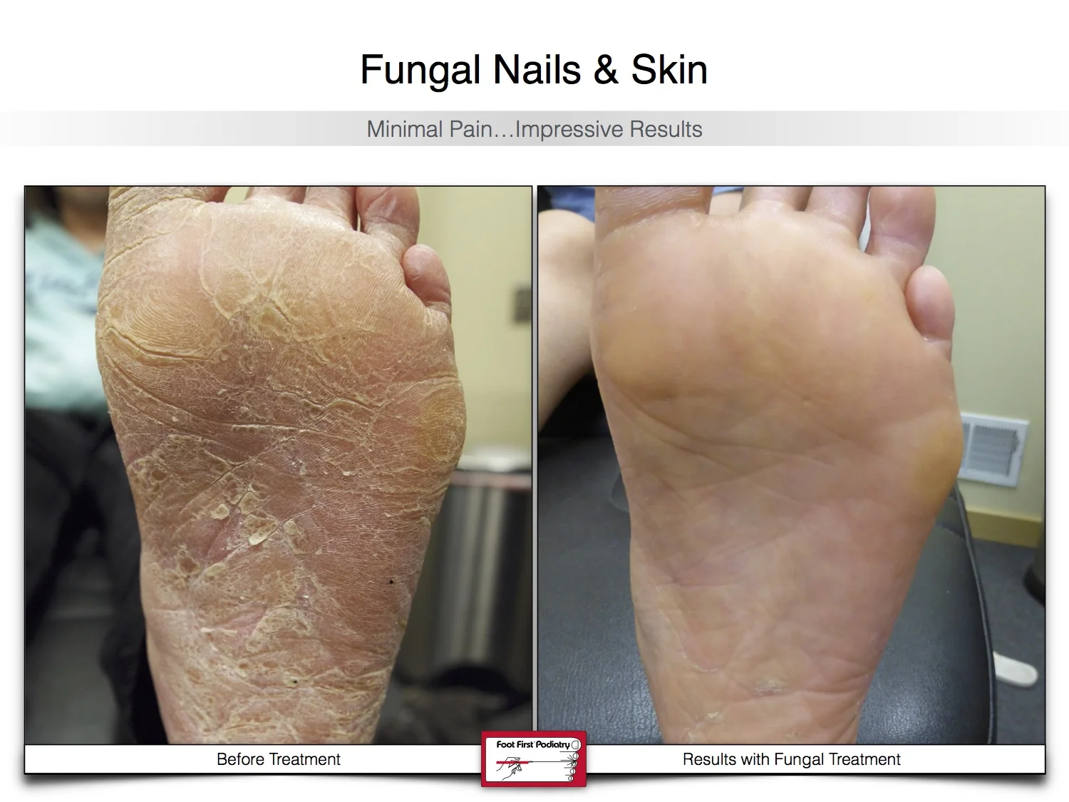 Fungal Nails — Foot First Podiatry Centers