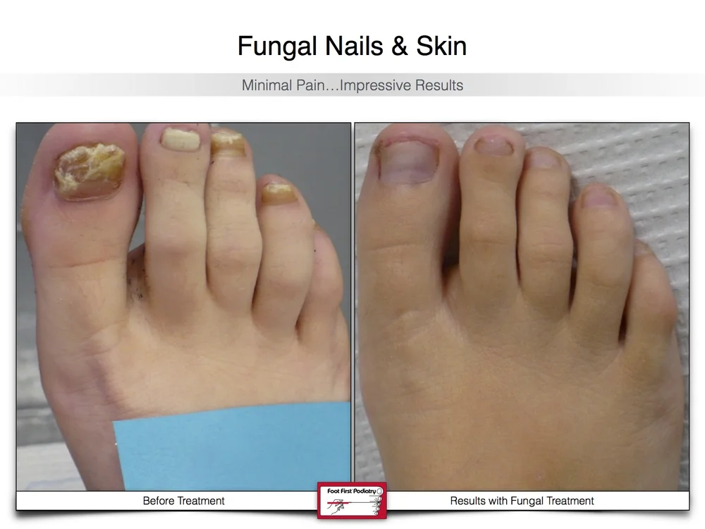 Fungal Nails — Foot First Podiatry Centers