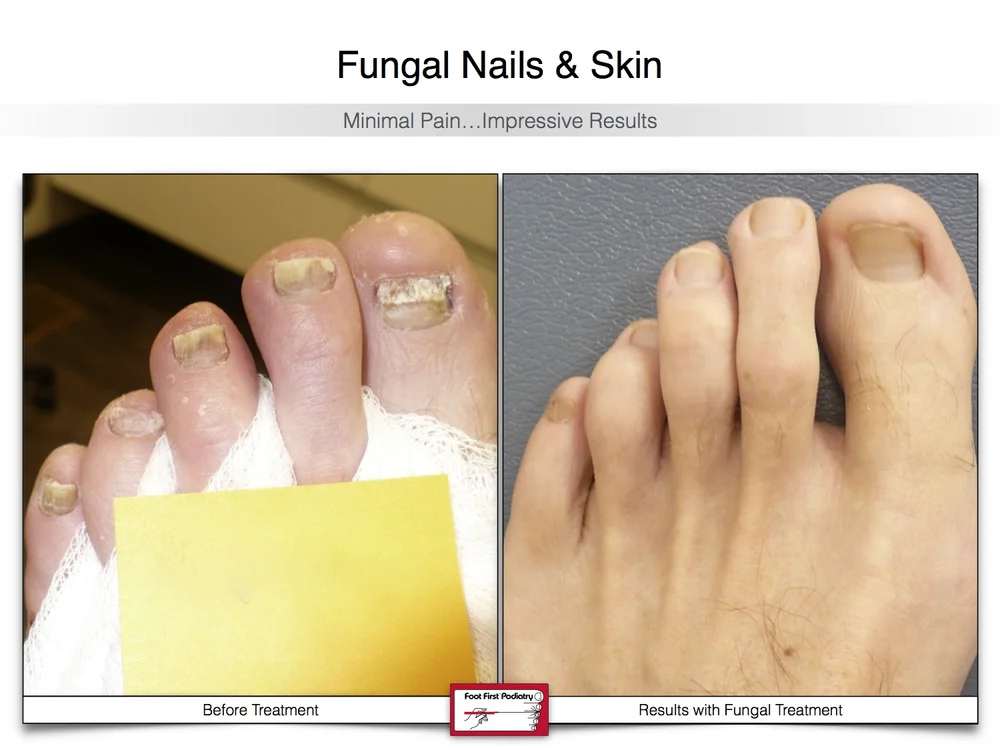 Fungal Nails — Foot First Podiatry Centers