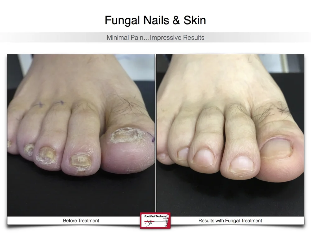 Fungal Nails — Foot First Podiatry Centers