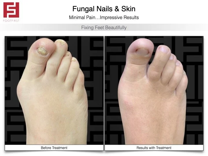 Fungal Nails — Foot First Podiatry Centers