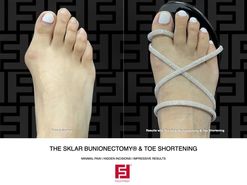 Toe Shortening and/or Straightening — Foot First Podiatry Centers
