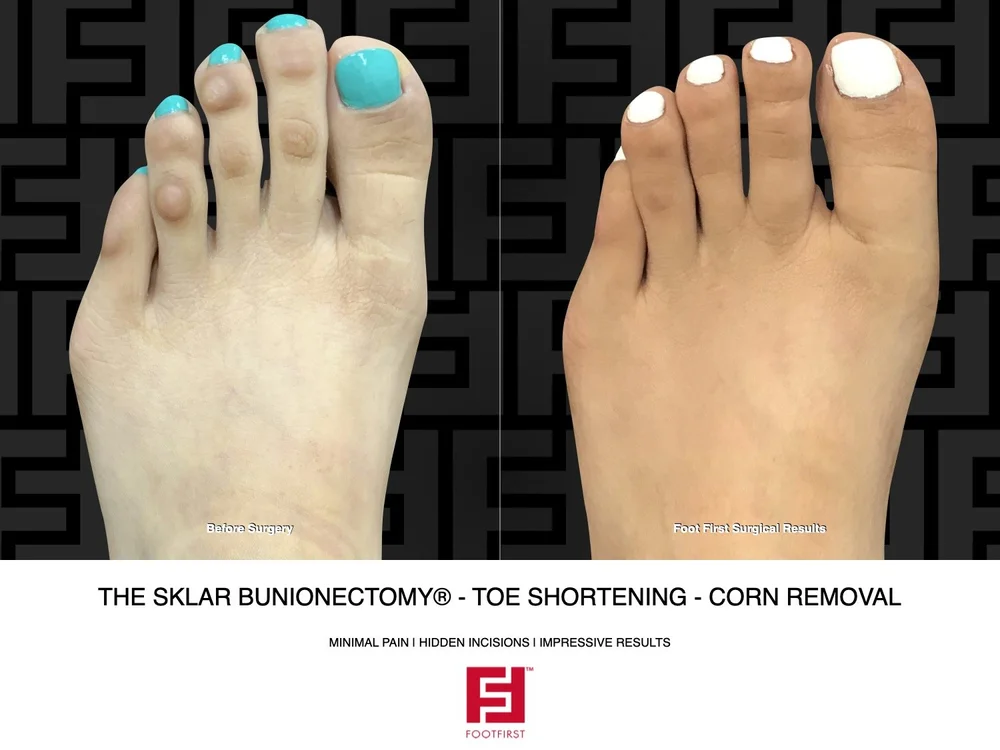 Corns — Foot First Podiatry Centers
