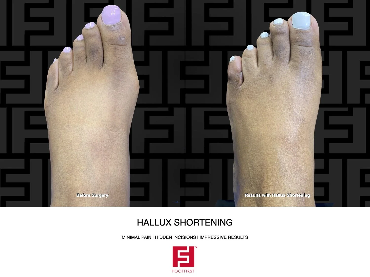 Bunion Surgery Scar On Top Of Foot Shop | emergencydentistry.com