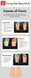 Causes of Corns and How we Fix Them! — Foot First Podiatry Centers
