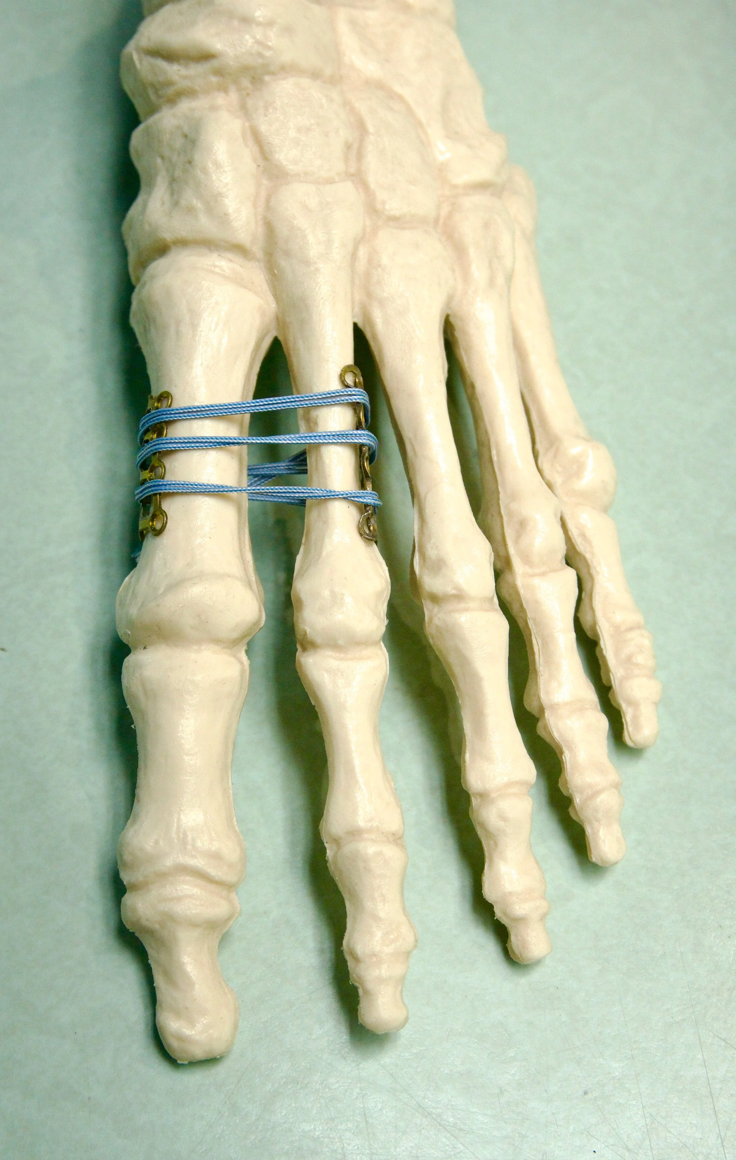 The syndesmosis bunionectomy — Bellevue Podiatric Physicians