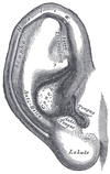 Pinna haematoma — entsho.com