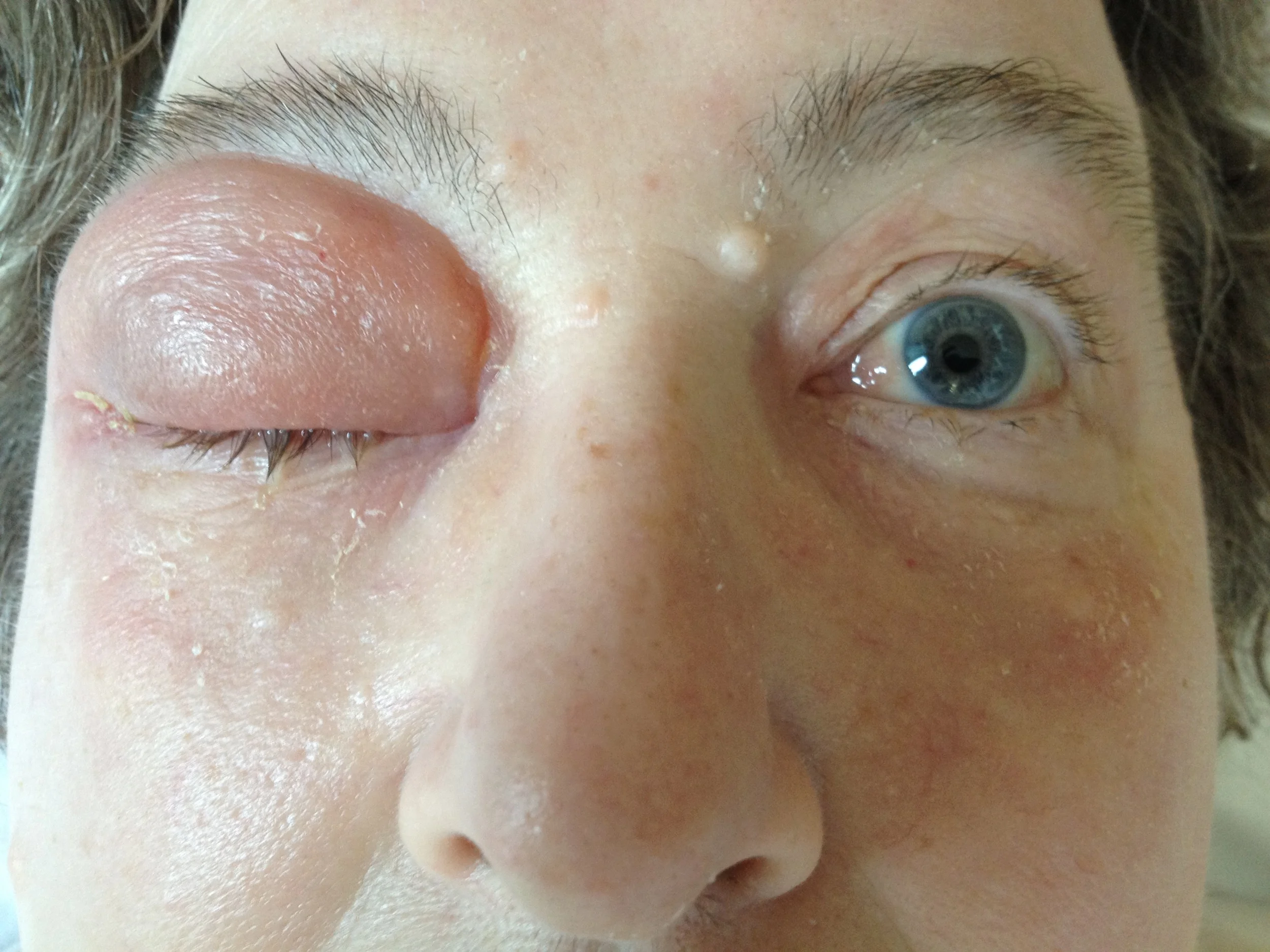 Periorbital Cellulitis Entsho