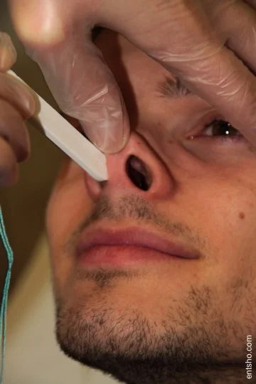 Anterior nasal packing — entsho.com