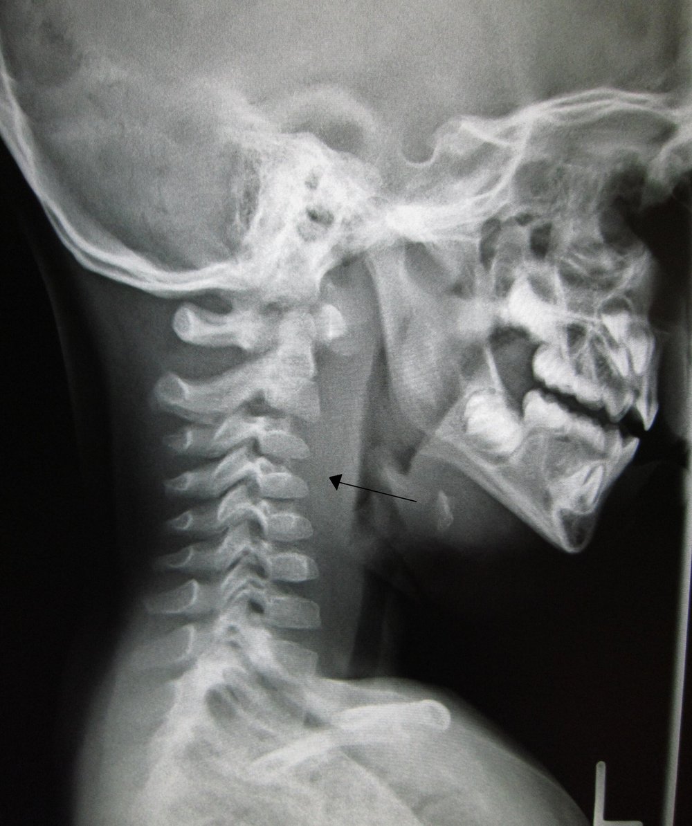Deep neck space infections — entsho.com