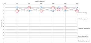Audiometry — entsho.com