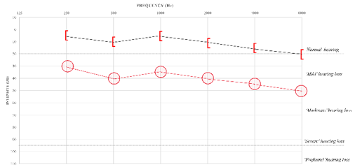 Audiometry — entsho.com