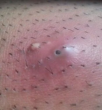 Ingrown hairs - a painful problem!! — Aspen Hair, Beauty & Laser Hair ...