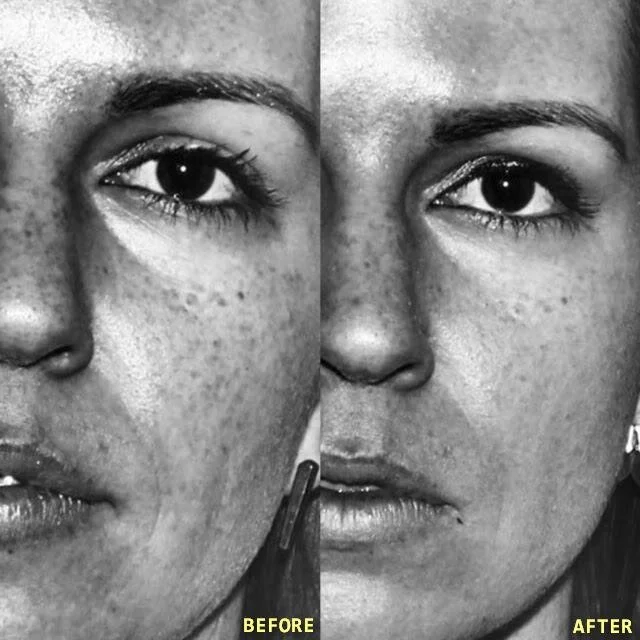 The Facial Rejuvenation Secret - Vampire Facials — Doctor Kate Kass