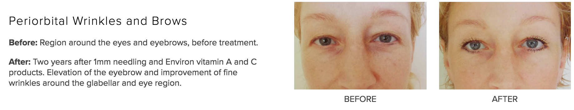 MICRO NEEDLING AT HOME — Skin City