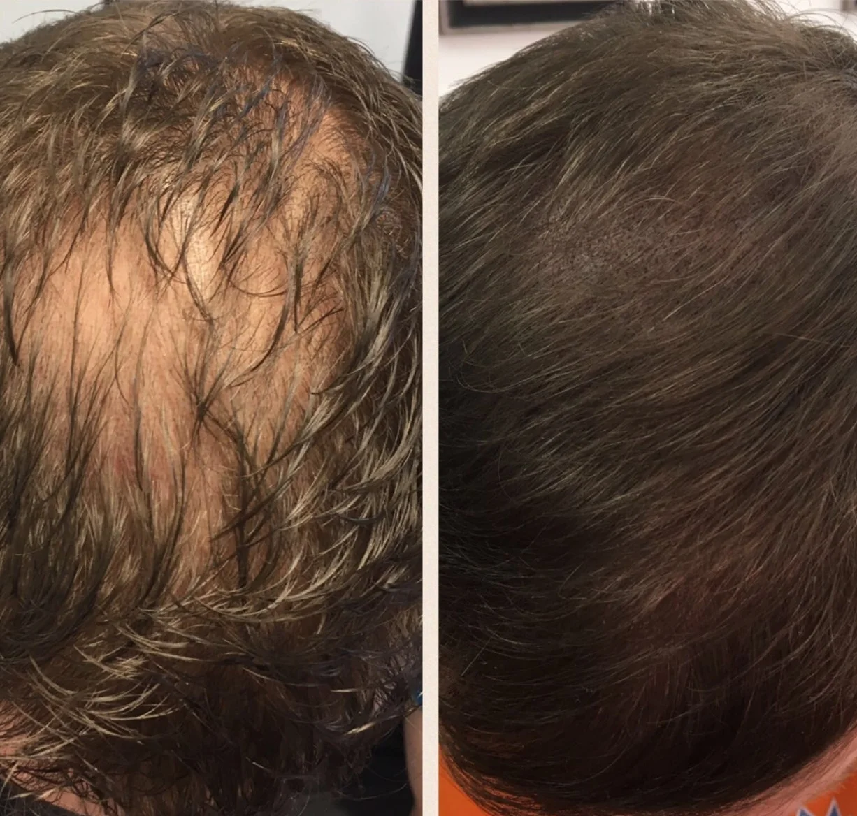 Male Hair Loss Treatment | Chaps Canterbury