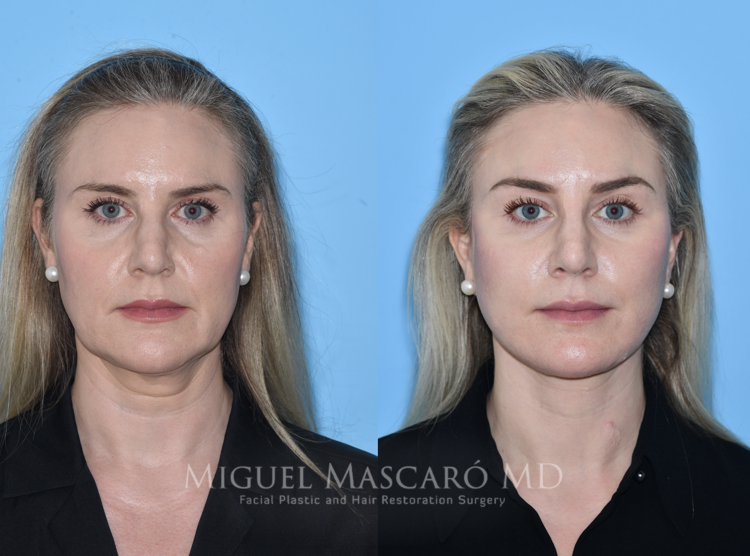 Face and neck lift — Miguel Mascaró MD