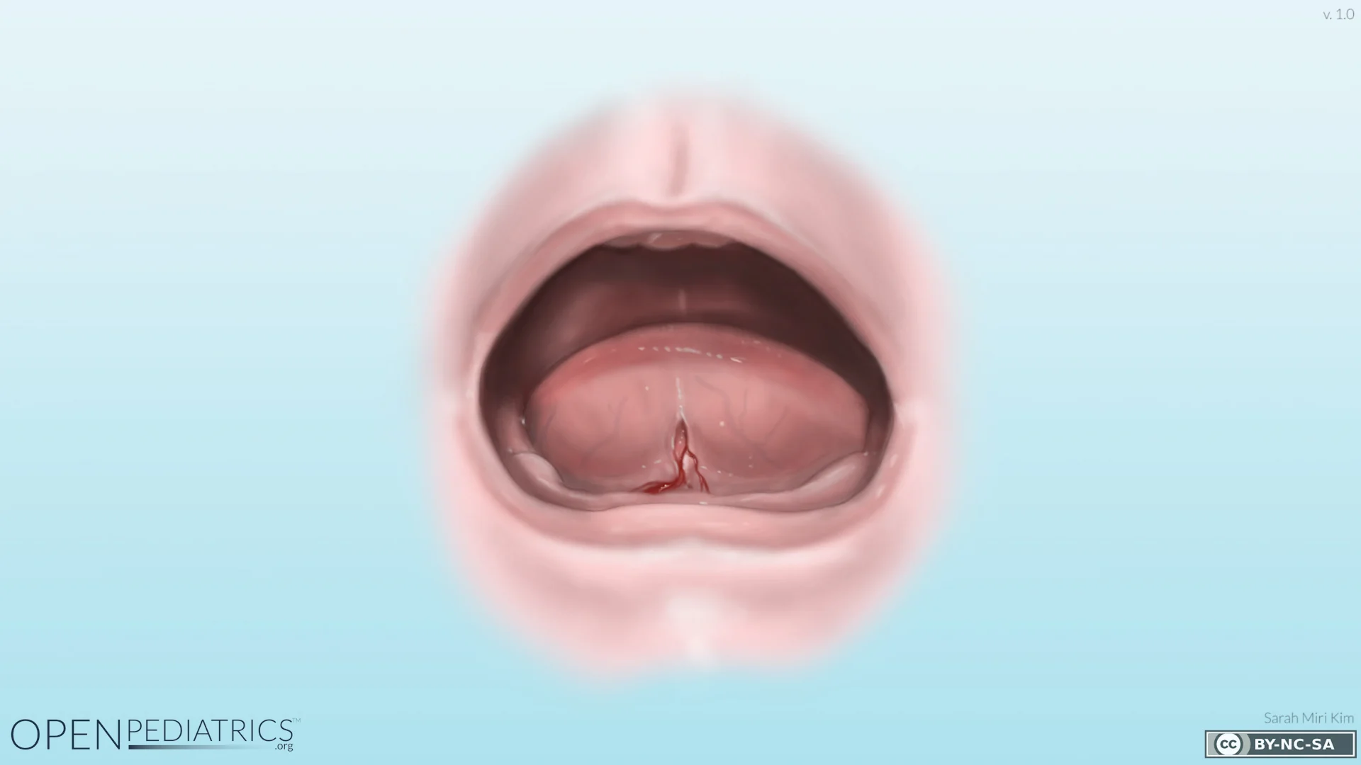 Torn Frenulum