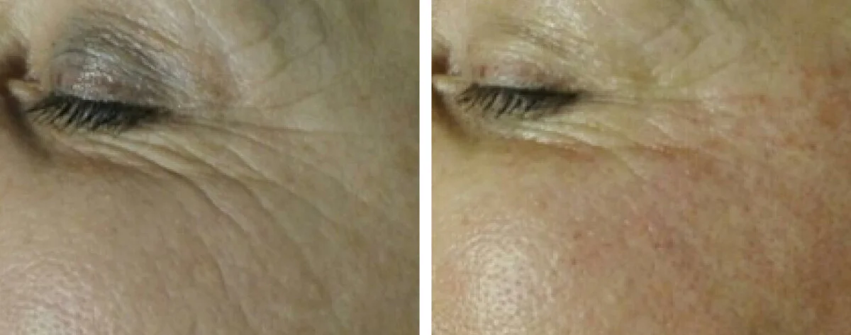 Fusion Mesotherapy | Professional Beauty Solutions