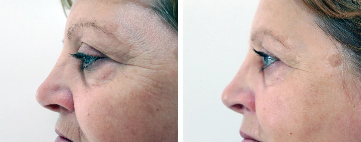 Fusion Mesotherapy | Professional Beauty Solutions