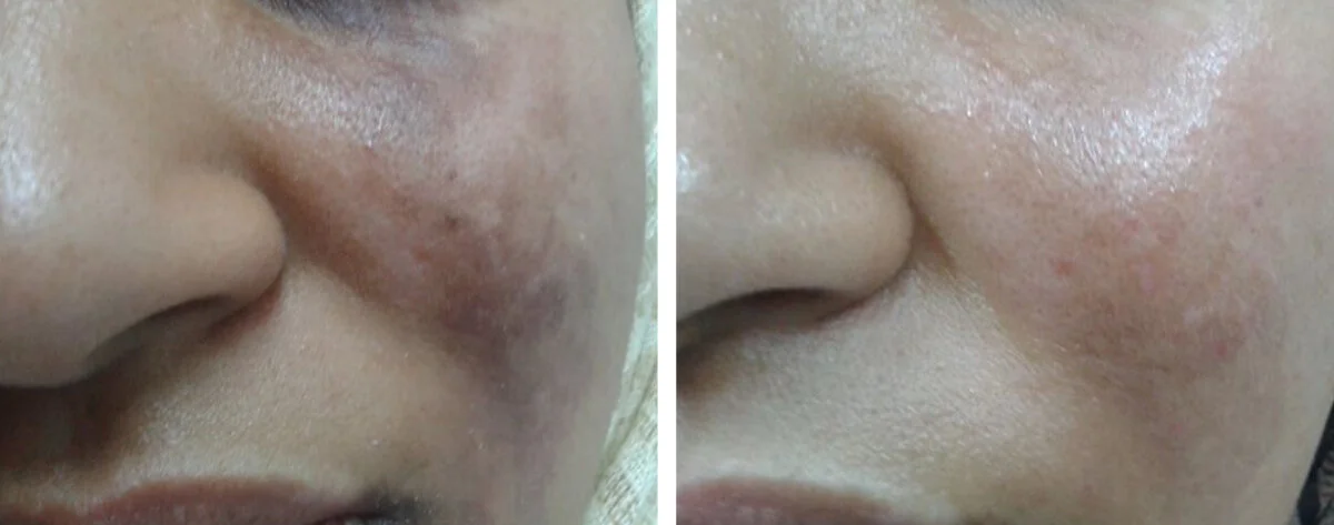 Fusion Mesotherapy | Professional Beauty Solutions