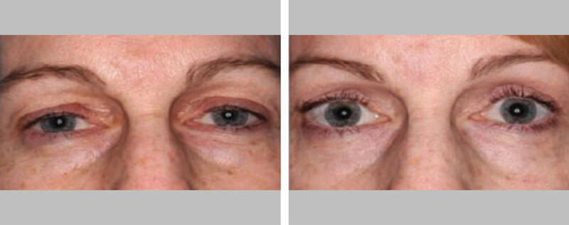 Fusion Mesotherapy | Professional Beauty Solutions