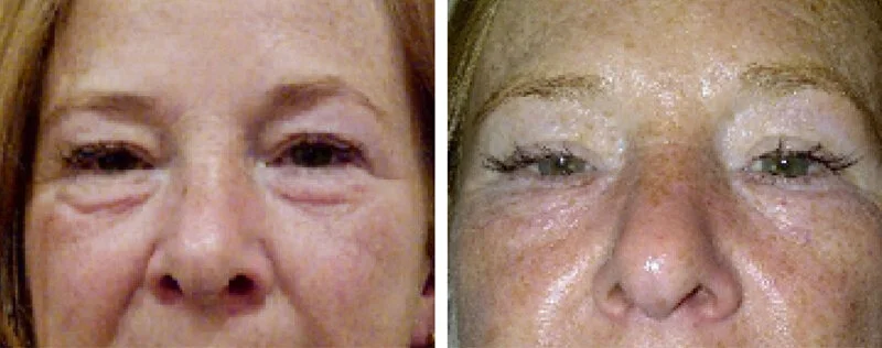 Fusion Mesotherapy | Professional Beauty Solutions