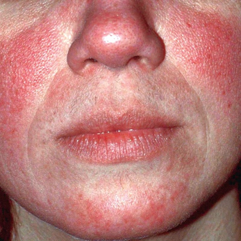 Is Blue Light Ok For Rosacea | Shelly Lighting