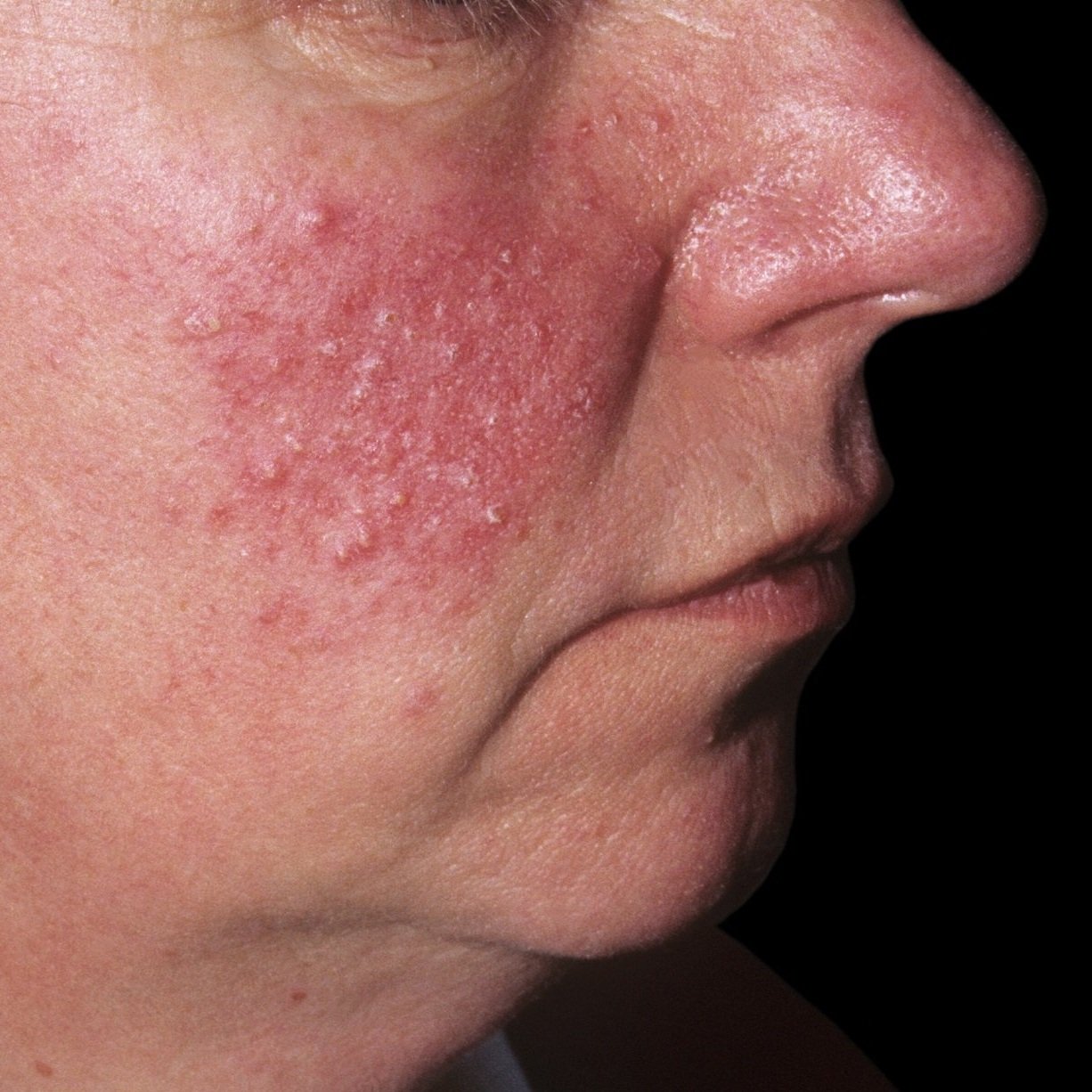 How-To-Treat-Rosacea — Professional Beauty Solutions