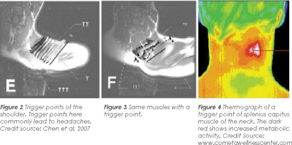 Myofascial Trigger Points (EXPLAINED)