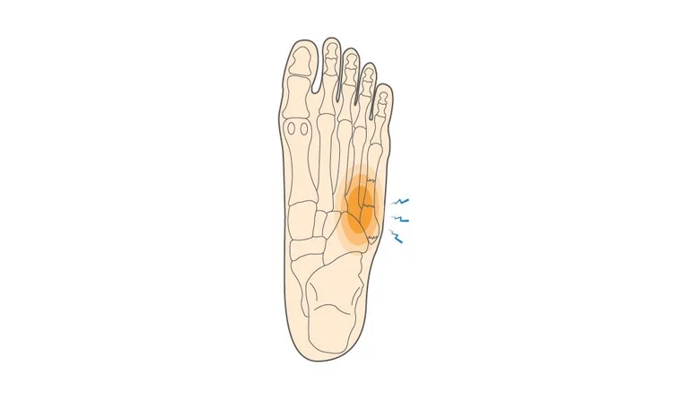When an Ankle Sprain isn't just an Ankle Sprain