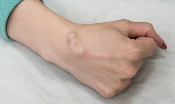 Why do I have a bump that feels like a bone? Enchondroma