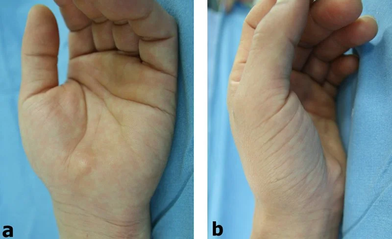 Why do I have a bump that feels like a bone? Enchondroma