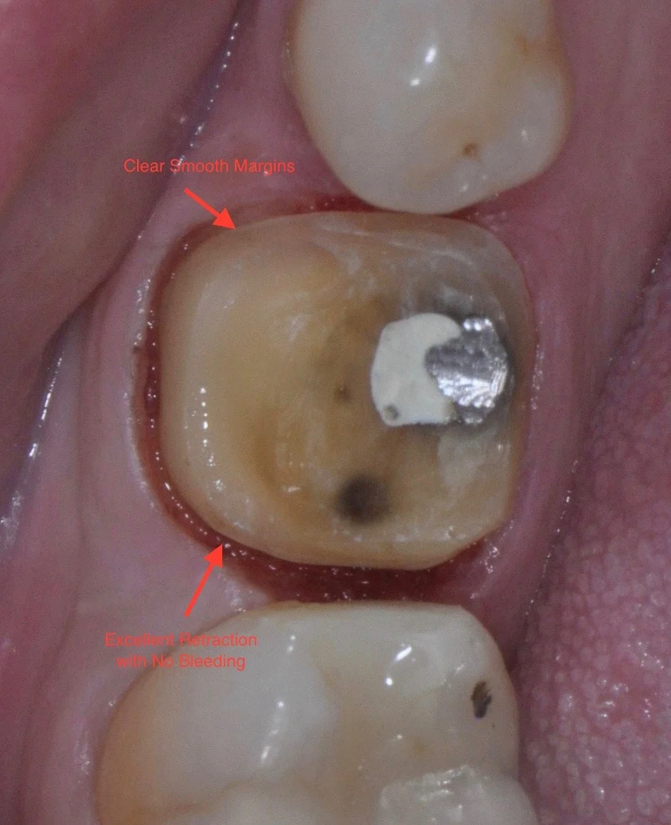 Why do I need a crown? | CJ Henley, DMD | Jacksonville, FL