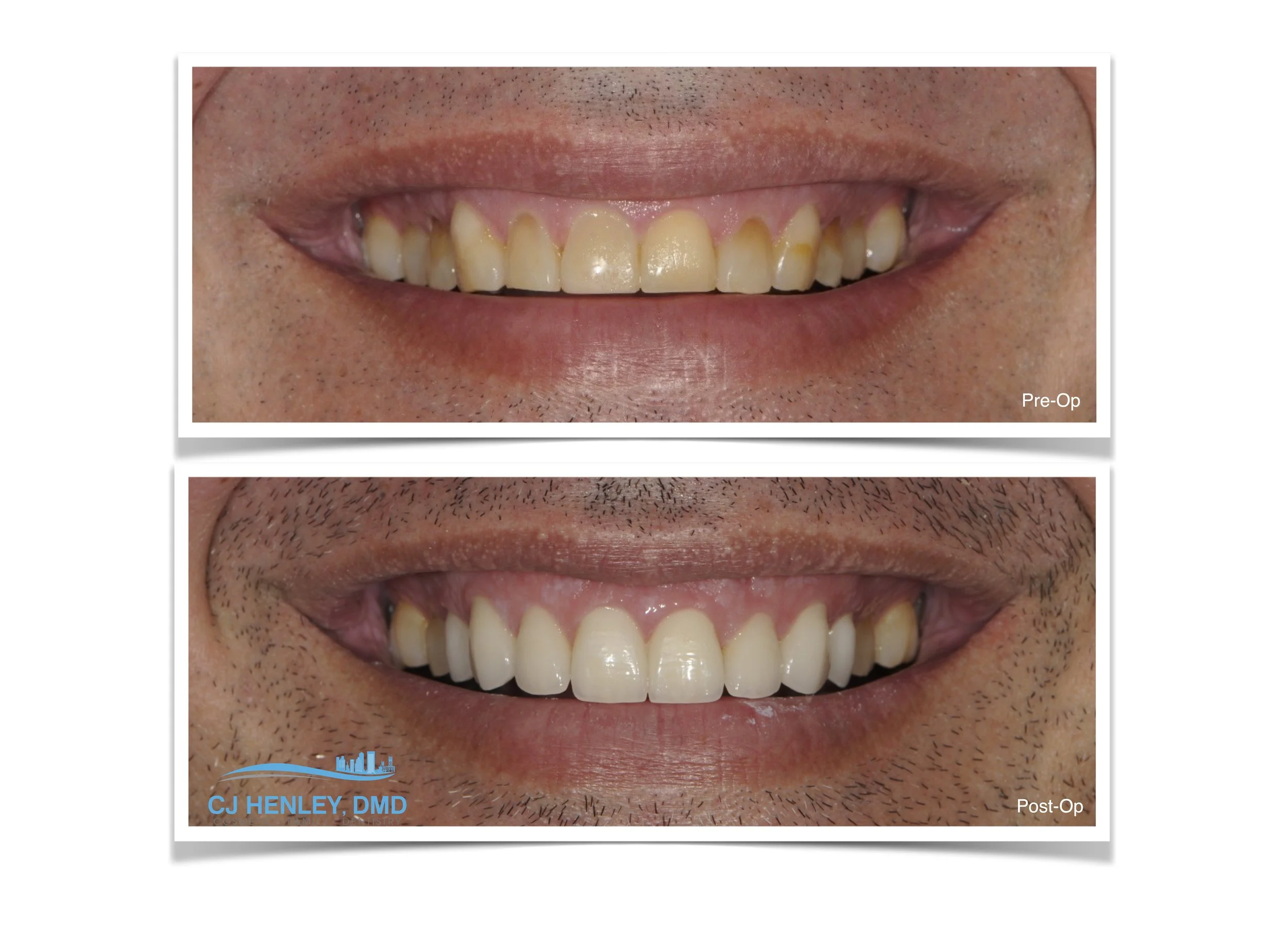 Smile Makeovers & Cosmetic Dentistry Results | CJ Henley DMD ...