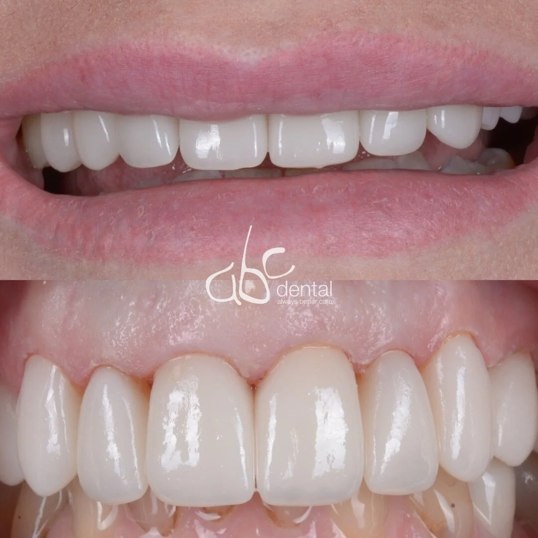 Cosmetic Smile Design, Lumineers, No-Prep Veneers to improve your most ...
