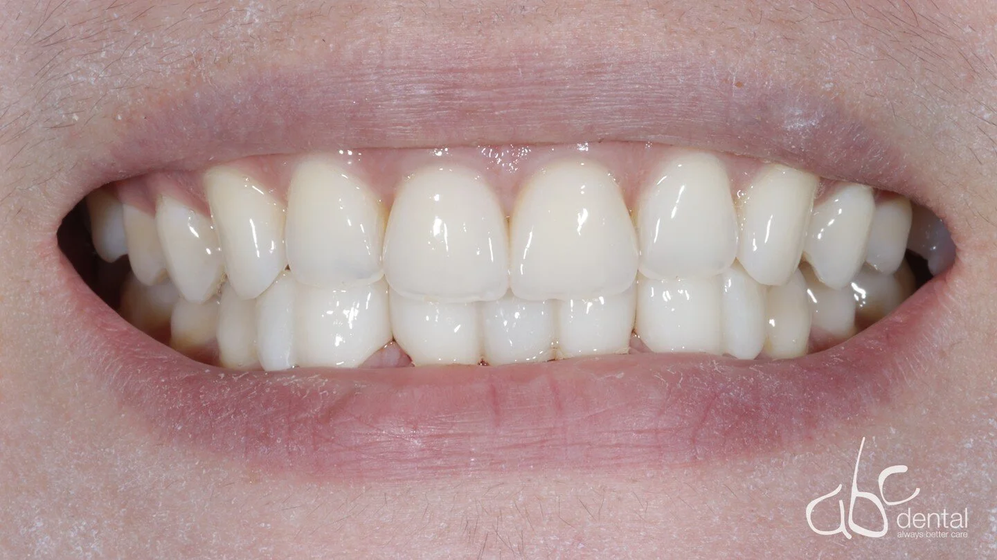 Cosmetic Smile Design, Lumineers, No-Prep Veneers to improve your most ...