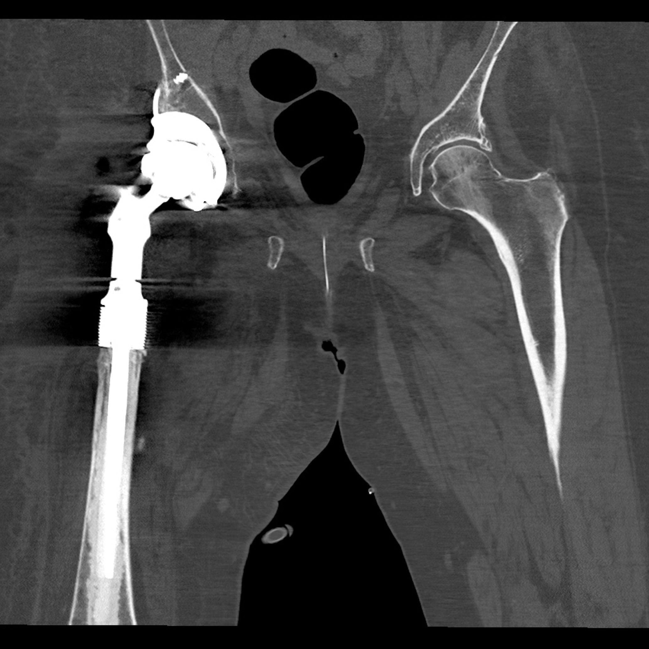 FEMORAL STEP SIX: CASE ONE - Proximal Femoral Replacement — Complex Hip ...
