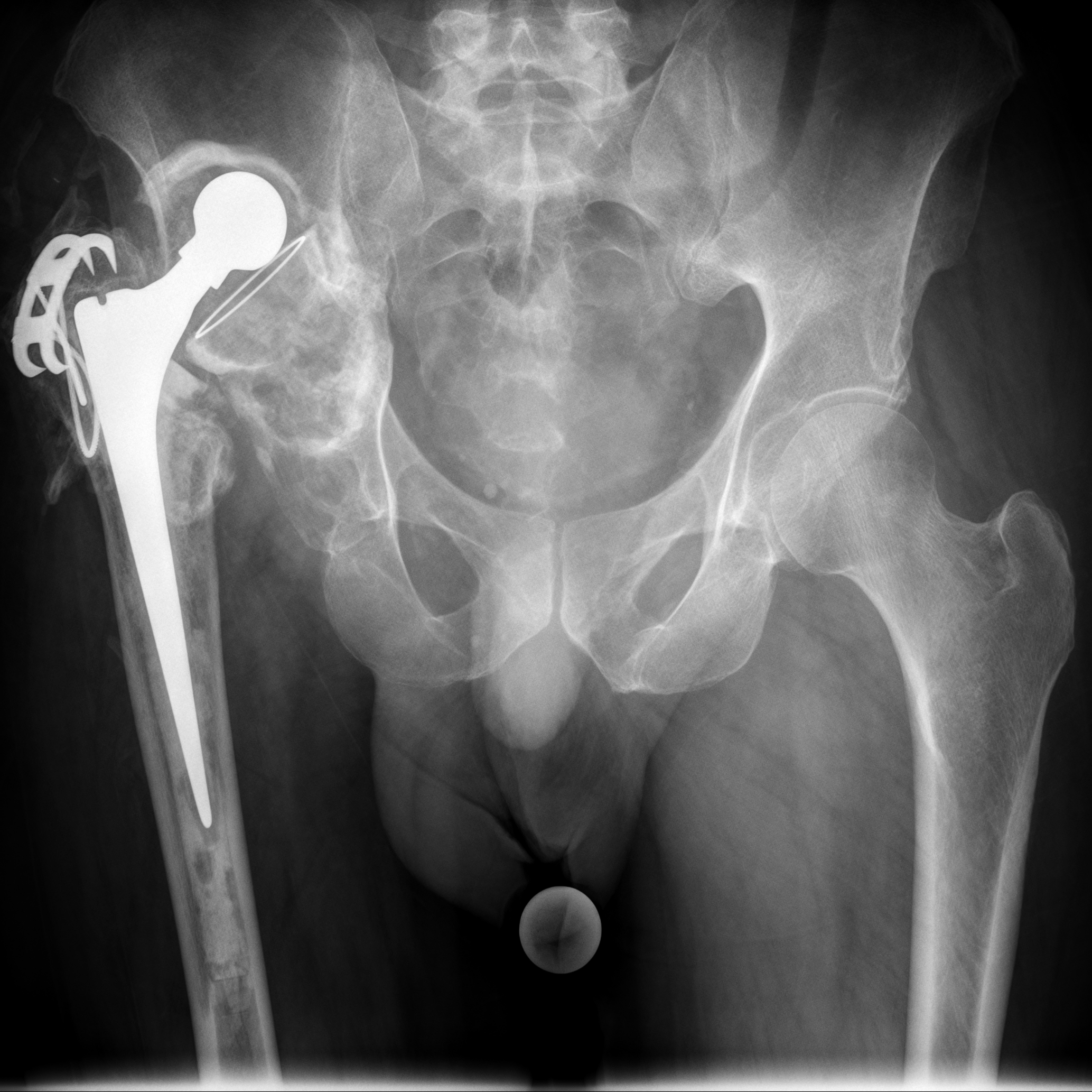 Complex Hip Surgery
