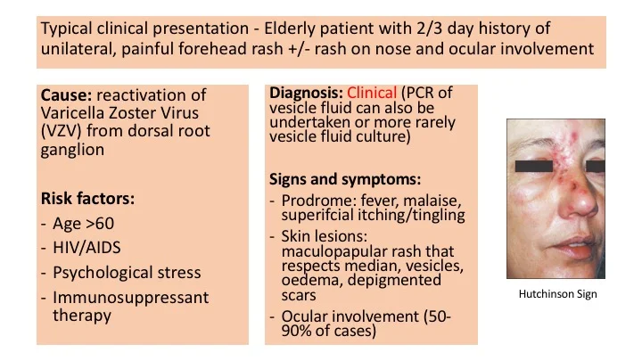 Herpes zoster ophthalmicus,what to know?