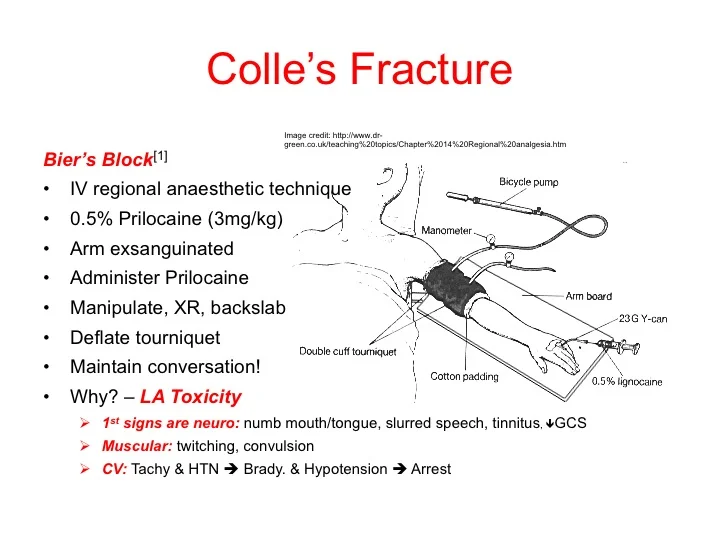 Colles Fracture — learnED