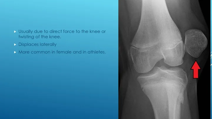 Patellar Dislocation — learnED