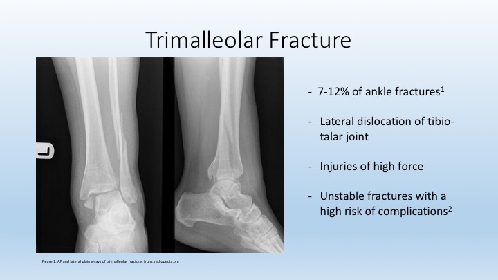 Trimalleolar Fracture — learnED